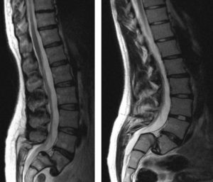 Spondylolisthese / Wirbelgleiten – Koller Wirbelsäule | Ihr Spezialist ...